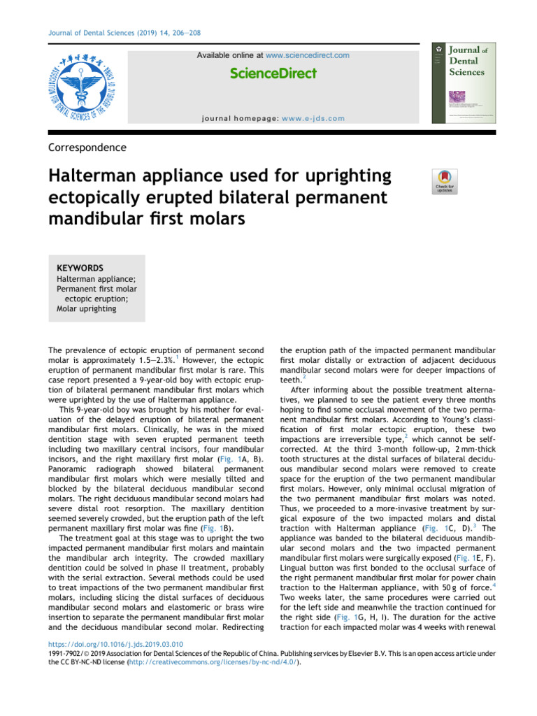 Halterman Appliance Used For Uprightingectopically Erupted Bilateral ...