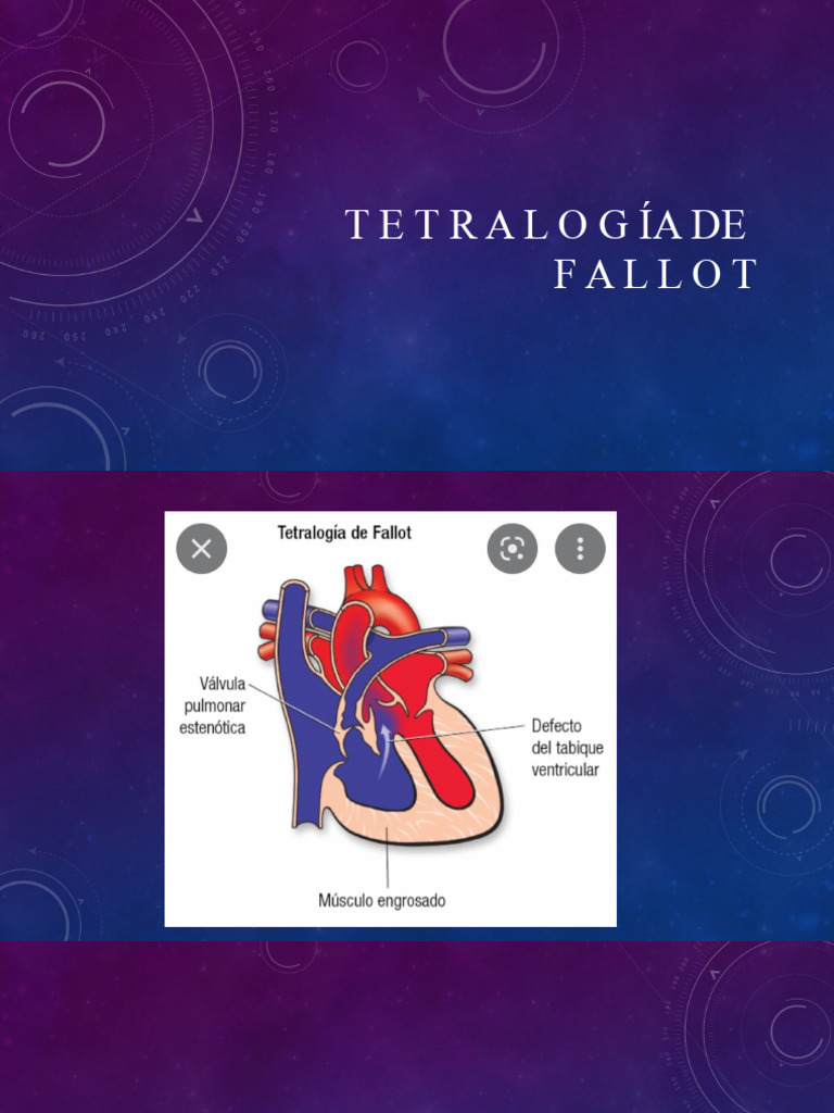 Tetralogía de Fallot: Causas y Tratamiento | PDF | Ventrículo (corazón ...
