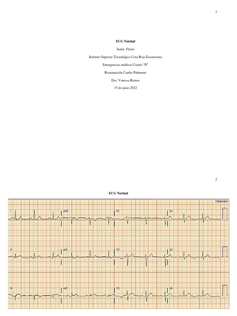 Ecg Normal JF | PDF