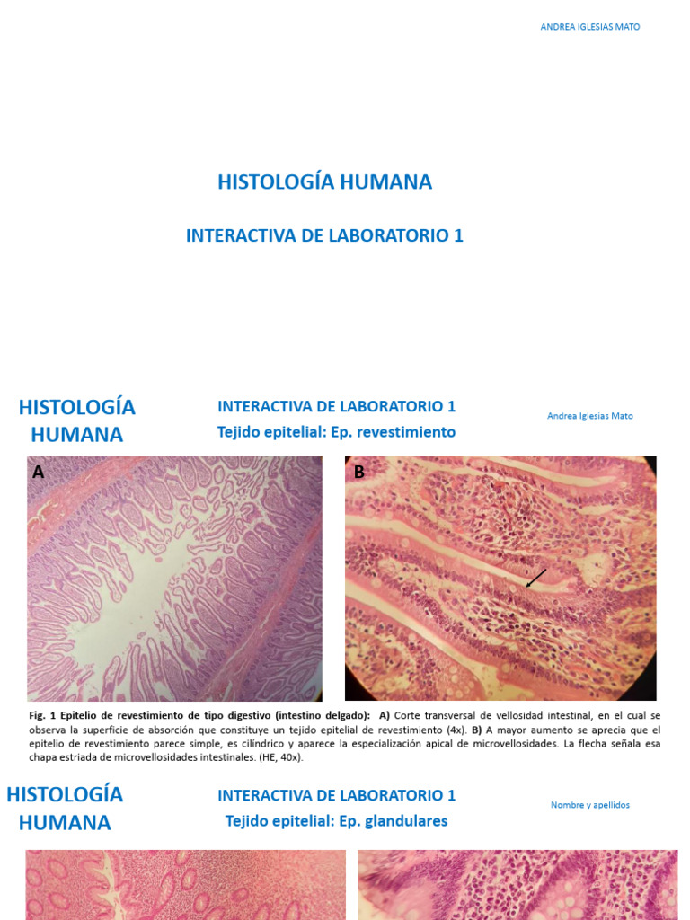 Perlas Córneas en Carcinoma Epidermoide | PDF | Epitelio | Tejido conectivo