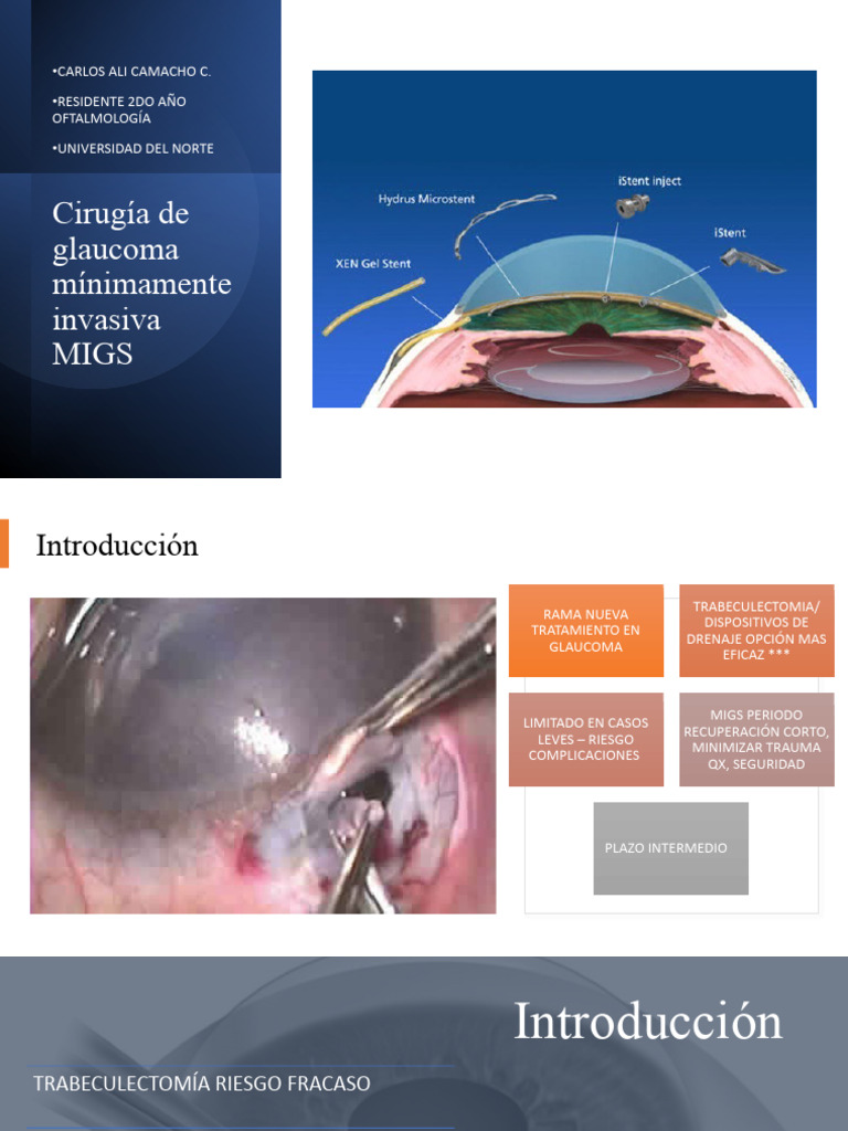 MIGS Glaucoma CAC | PDF | Glaucoma | Medicina