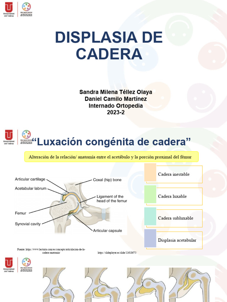 Displasia de Cadera | PDF | Ciencias de la Salud | Medicina