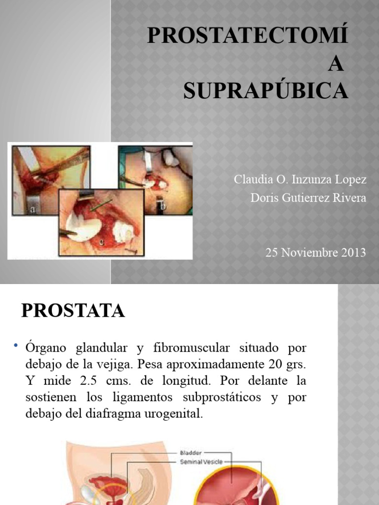 Prostatectomía Suprapúbica: Técnica Quirúrgica | PDF | Próstata ...