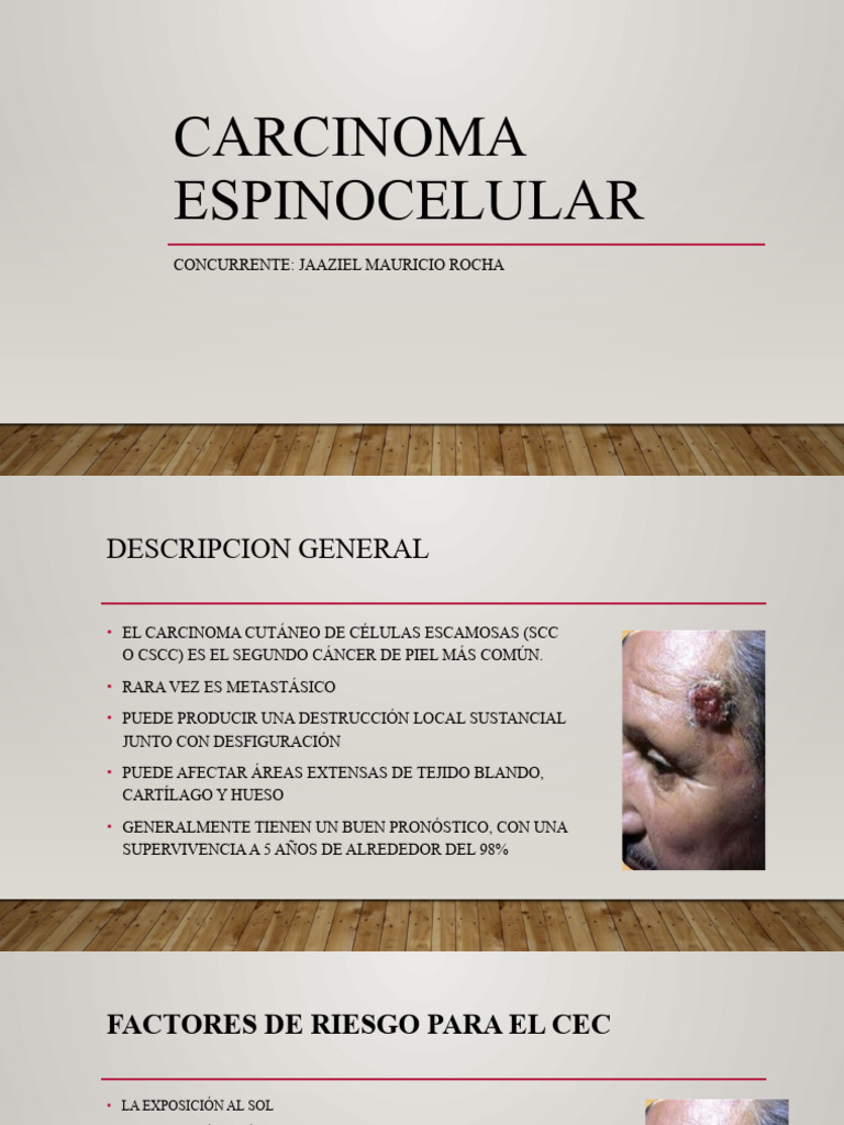 Carcinoma Espinocelular | Descargar gratis PDF | Metástasis | Cáncer