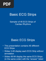 Pac PJC PVC | PDF | Cardiac Electrophysiology | Cardiac Arrhythmia