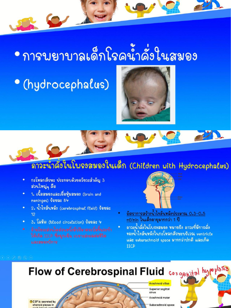 4.ภาวะน้ำคั่งในโพรงสมอง (Hydrocephalus) | PDF