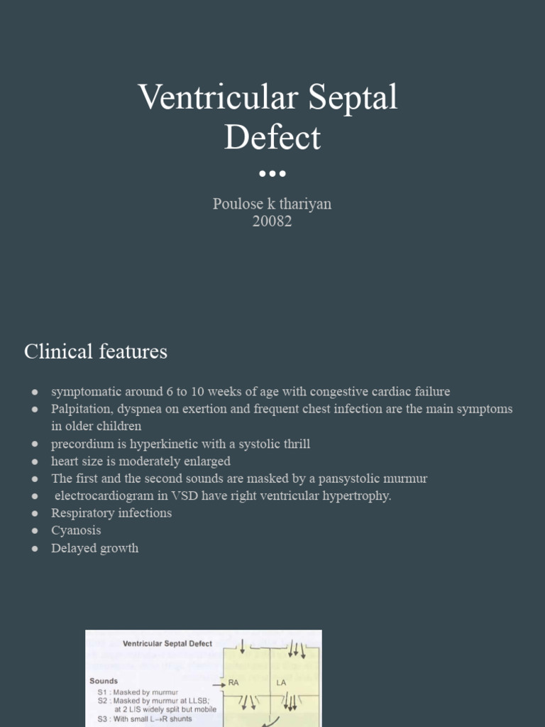 Clinical Features of Ventricular Septal Defect | PDF