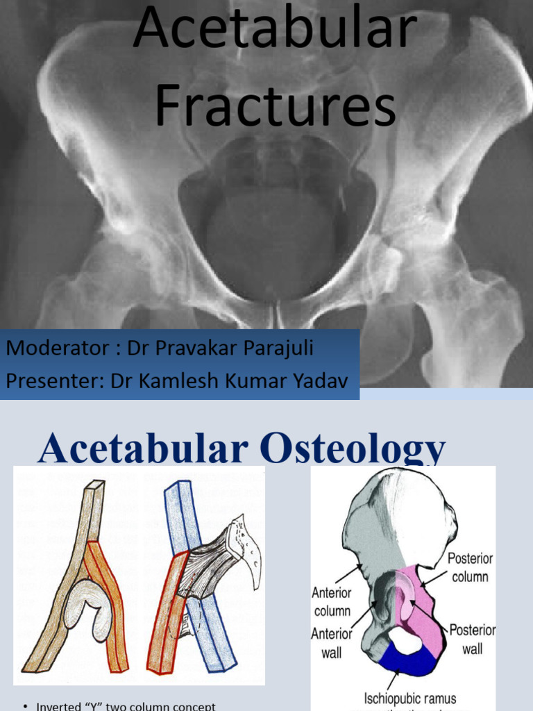 Fractures of Acetabulum | PDF | Pelvis | Hip
