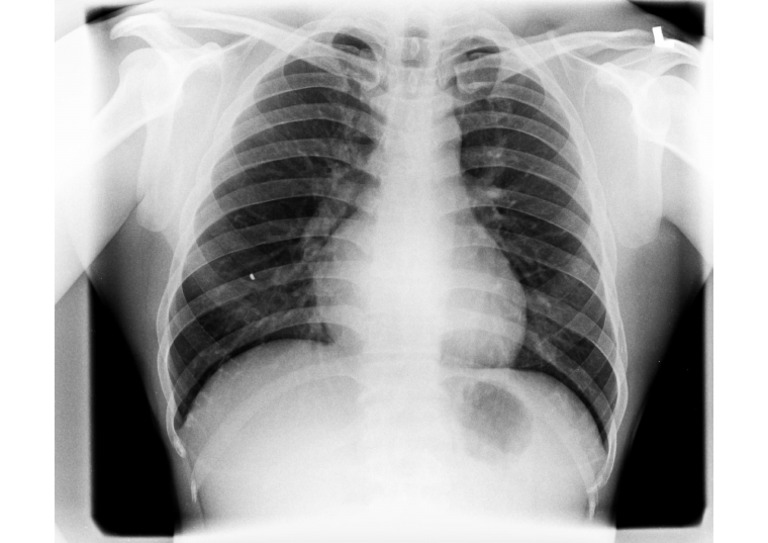 SUHRAWI XRAY FOMEMA CHEST X-RAY | PDF