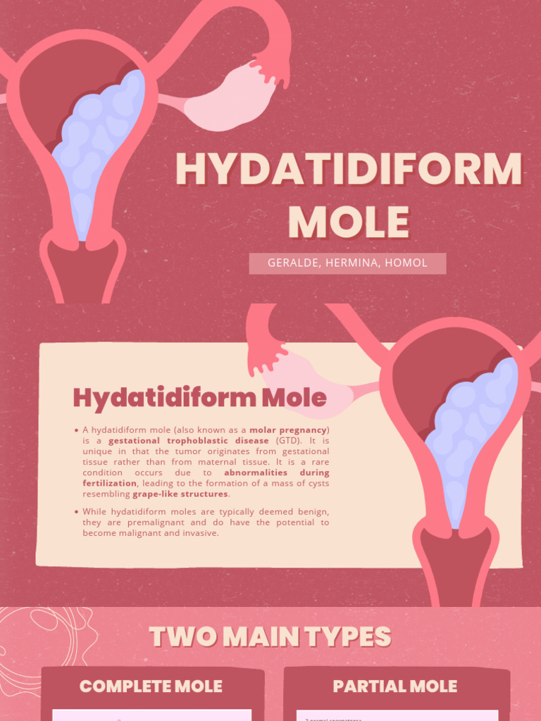 Hydatidiform MolE | PDF | Women's Health | Public Health