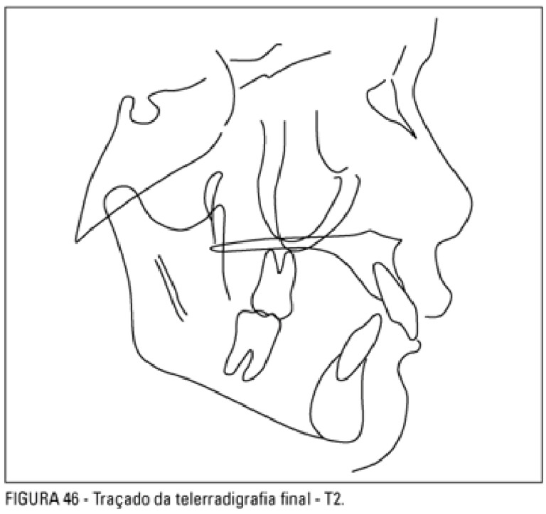 Cefalograma Classe II | PDF