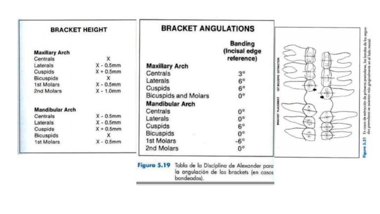 altura de brackets Alexander | PDF
