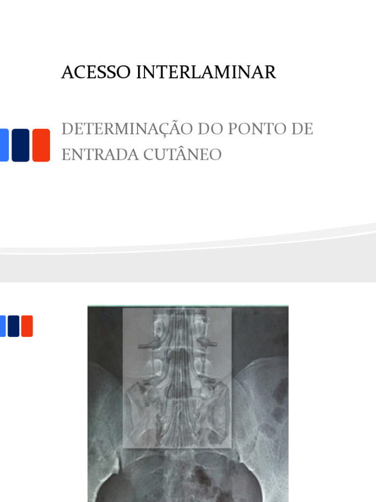 Determinação Do Ponto de Entrada Interlaminar | PDF | Shoulder | Pathology