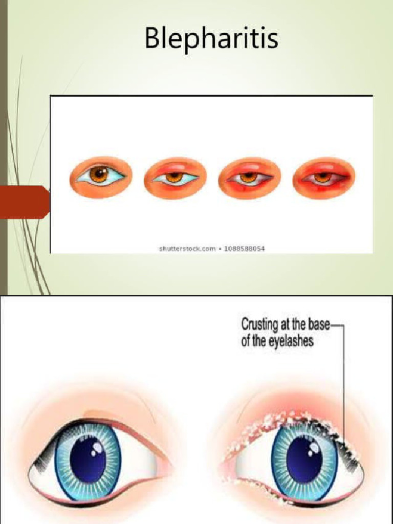 Eye Disorder Nursing | PDF