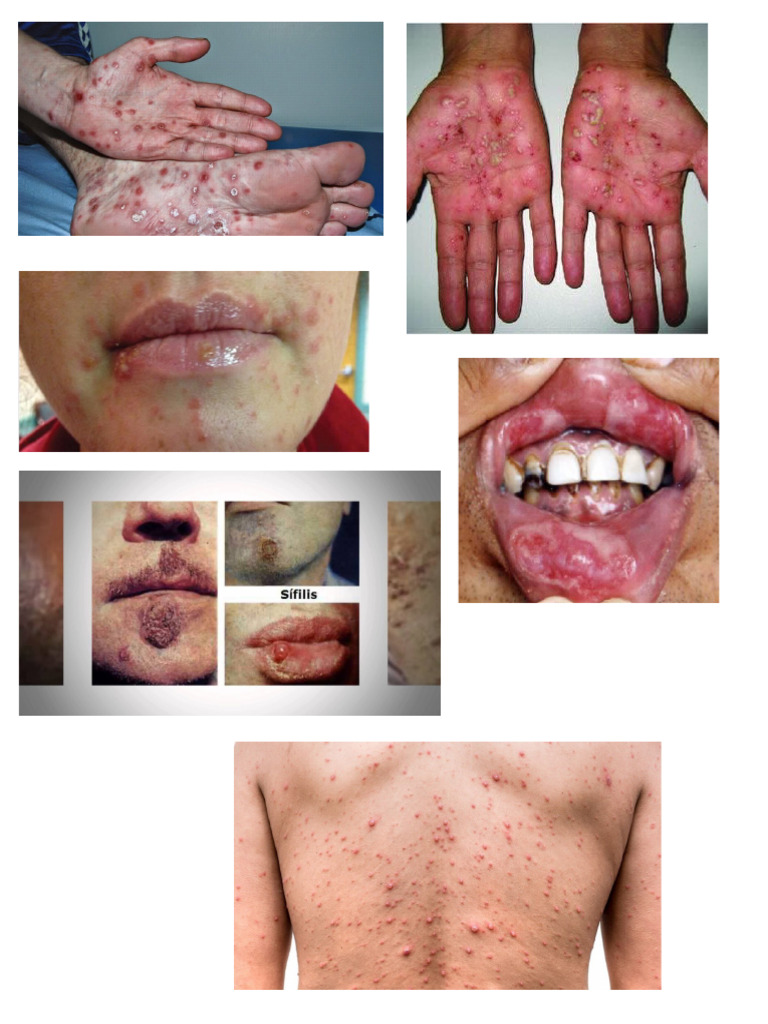 Sifilis Imagenes | PDF