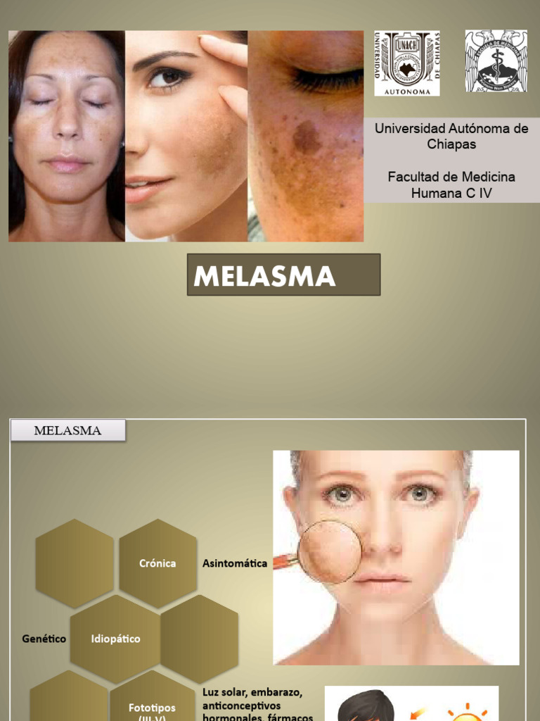 MELASMA | PDF | Epidermis | Piel