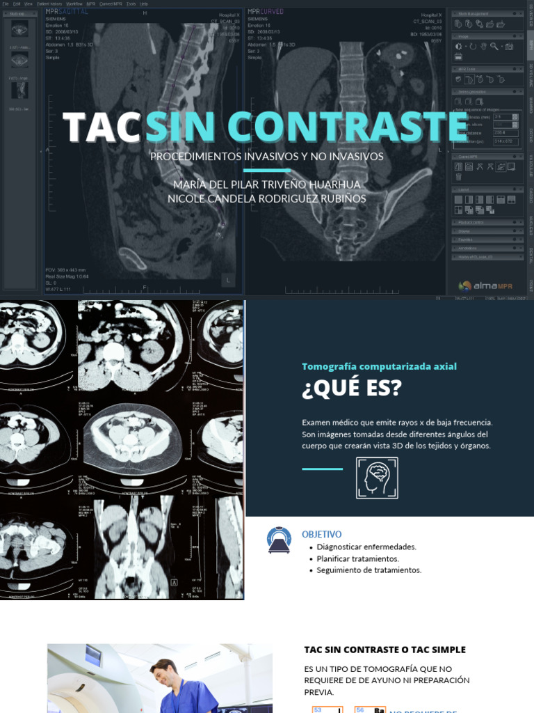 Sem 6 Tomografía Axial Computarizada Sin Contraste | PDF | Ct Scan ...