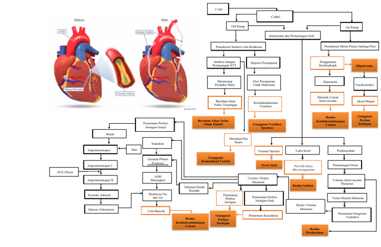 Pathway CABG | PDF