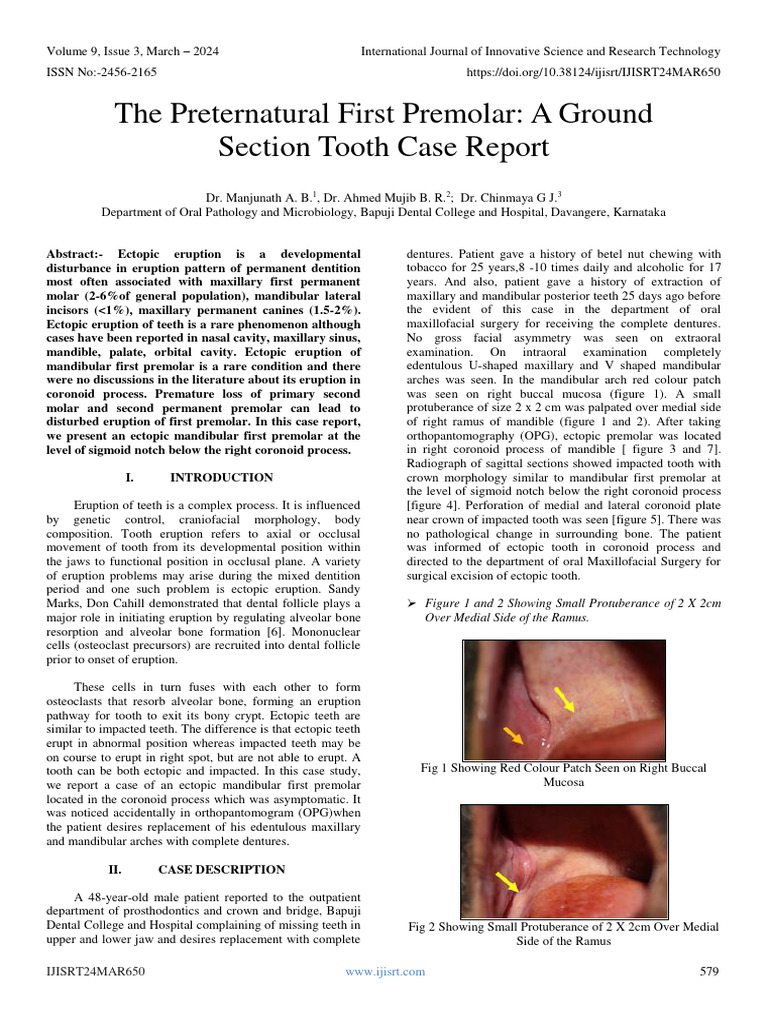 The Preternatural First Premolar: A Ground Section Tooth Case Report ...