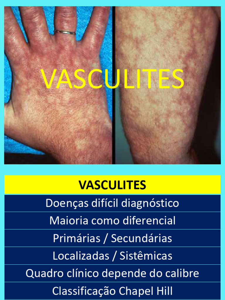 VASCULITES | PDF