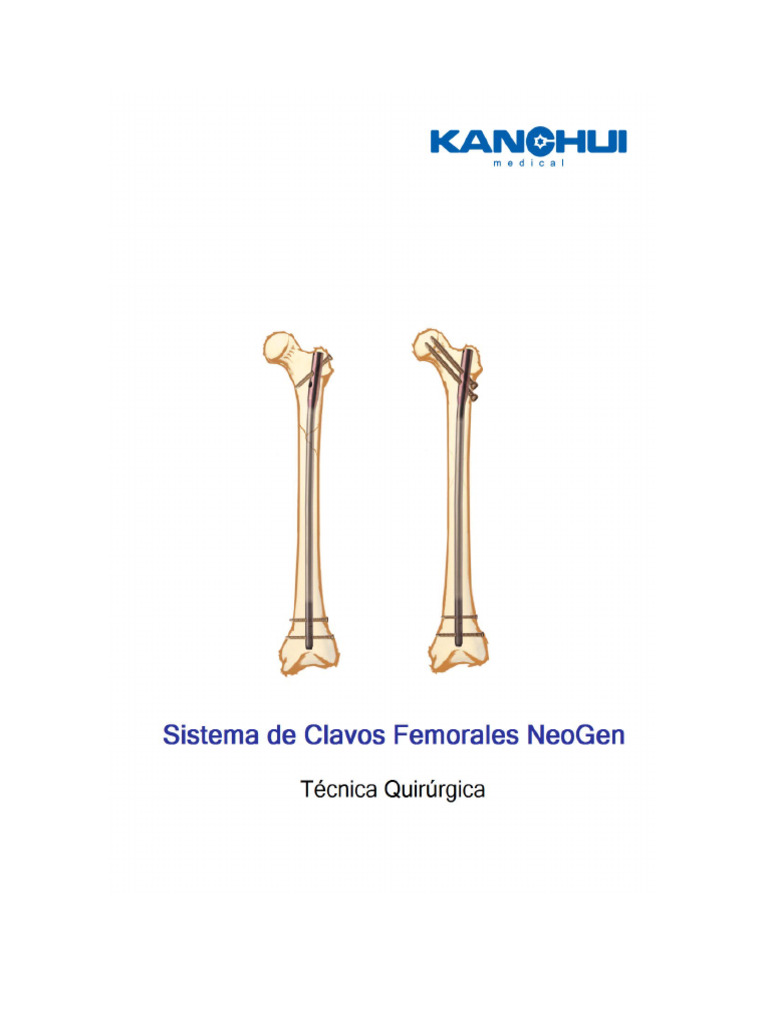 Sistema de Clavos Femorales NeoGen (3) | PDF