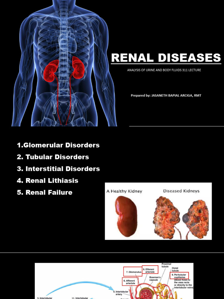 RENAL DISEASES | PDF | Kidney Disease | Causes Of Death