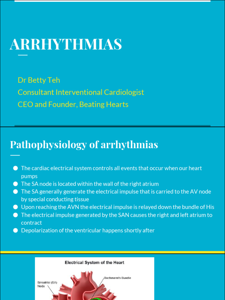 ARRHYTHMIA | PDF | Heart | Atrium (Heart)