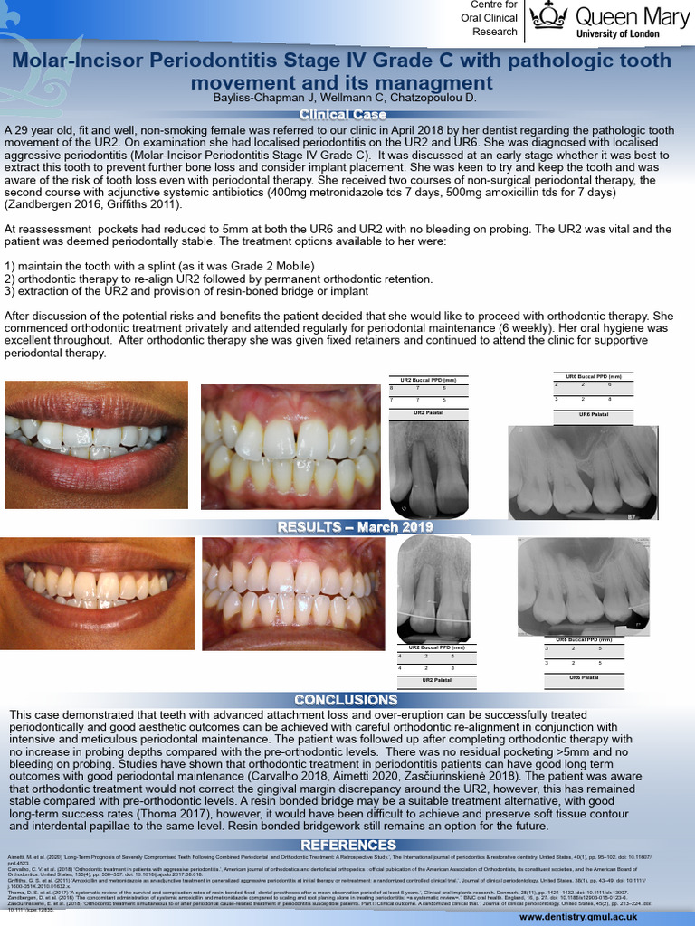 J Bayliss Chapman POSTER - Molar-Incisor Periodontitis Stage IV Grade C ...