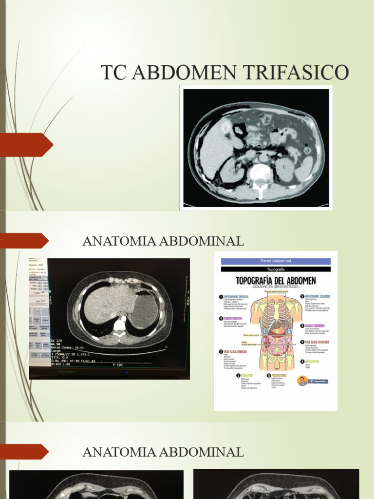 TAC Abdominal Trifásico: Protocolo y Anatomía | PDF