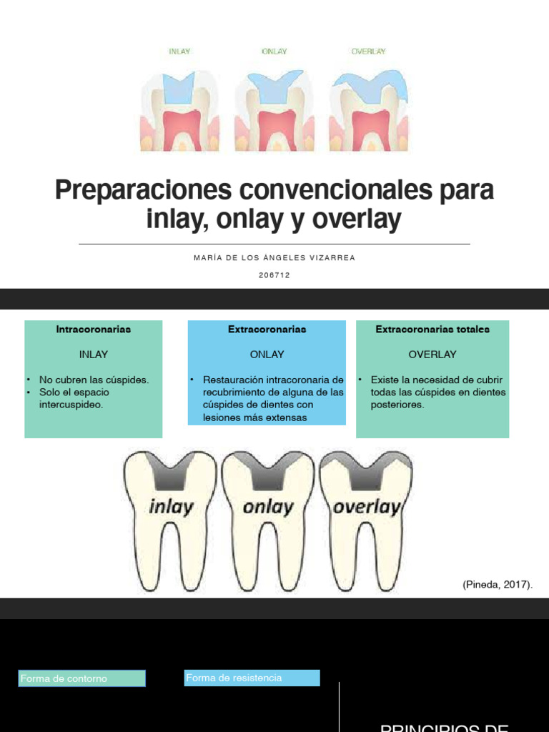 Preparaciones para Inlay, Onlay y Overlay | PDF | Boca | Odontología