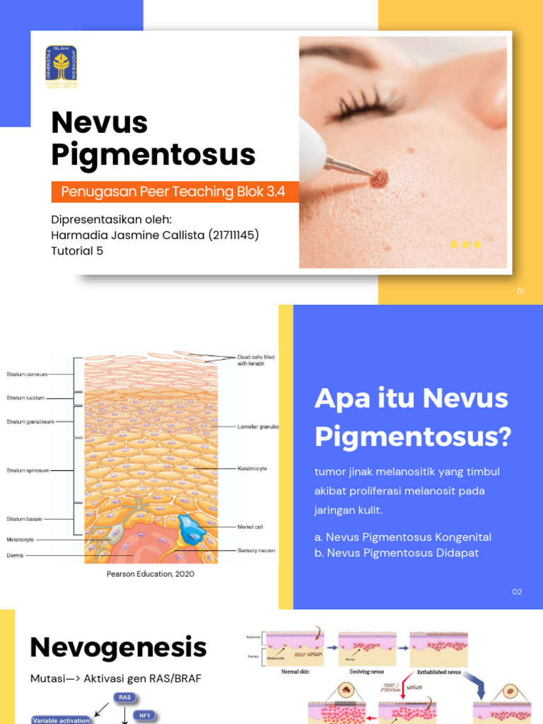 Nevus Pigmentosus | PDF