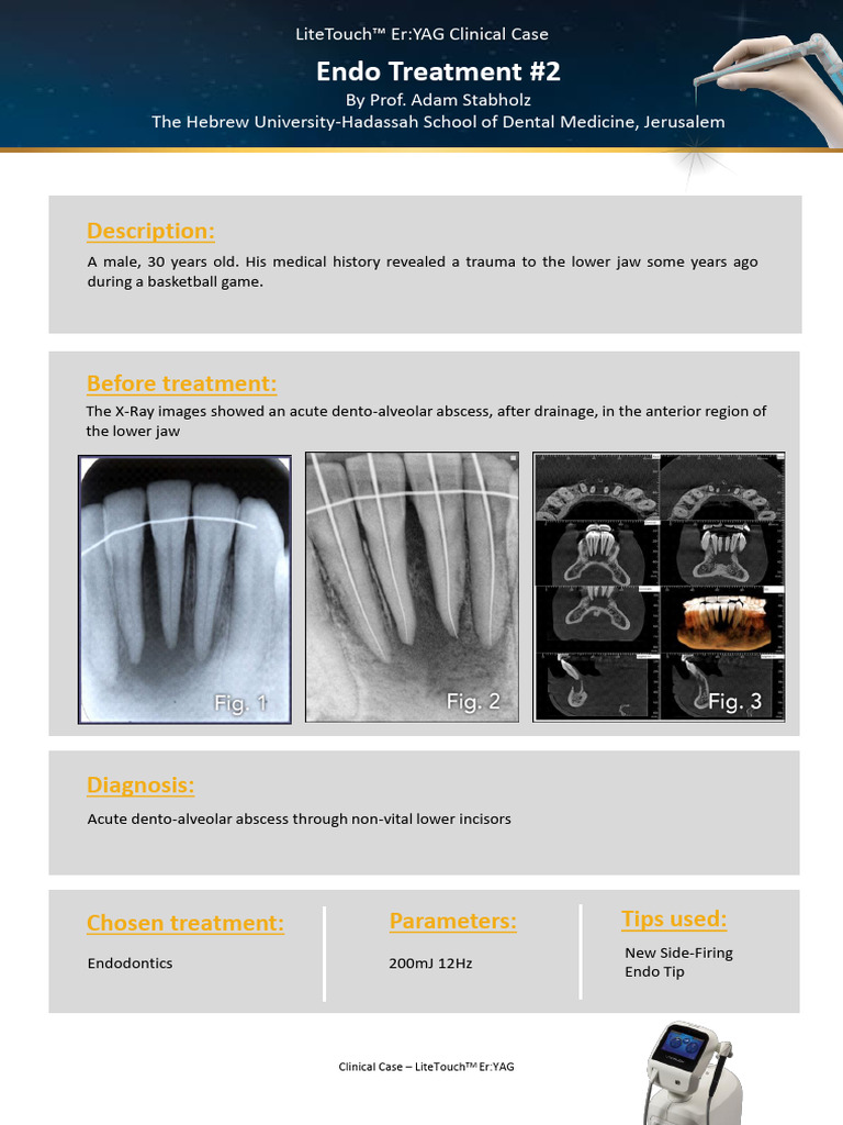 Endo-Treatment-2-with-LiteTouch™-Er-YAG-dental-laser | PDF
