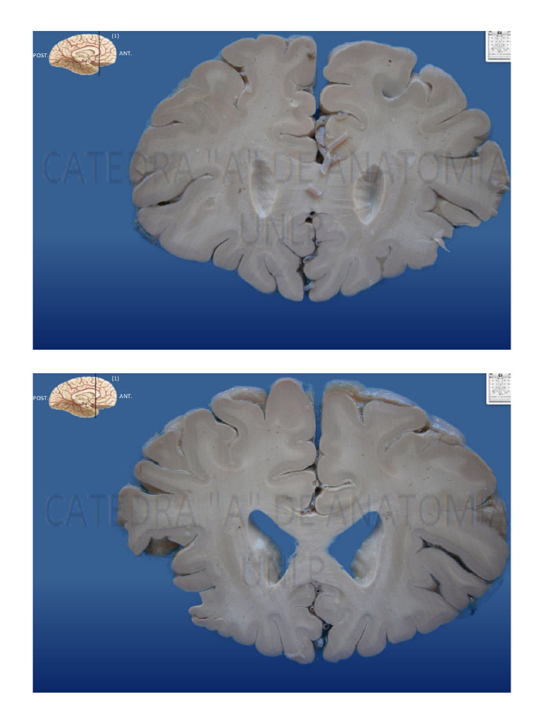 Cerebro Fleshing y Charcott | PDF
