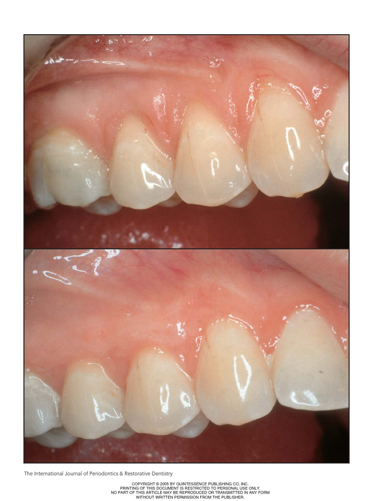 The International Journal of Periodontics & Restorative Dentistry | PDF ...