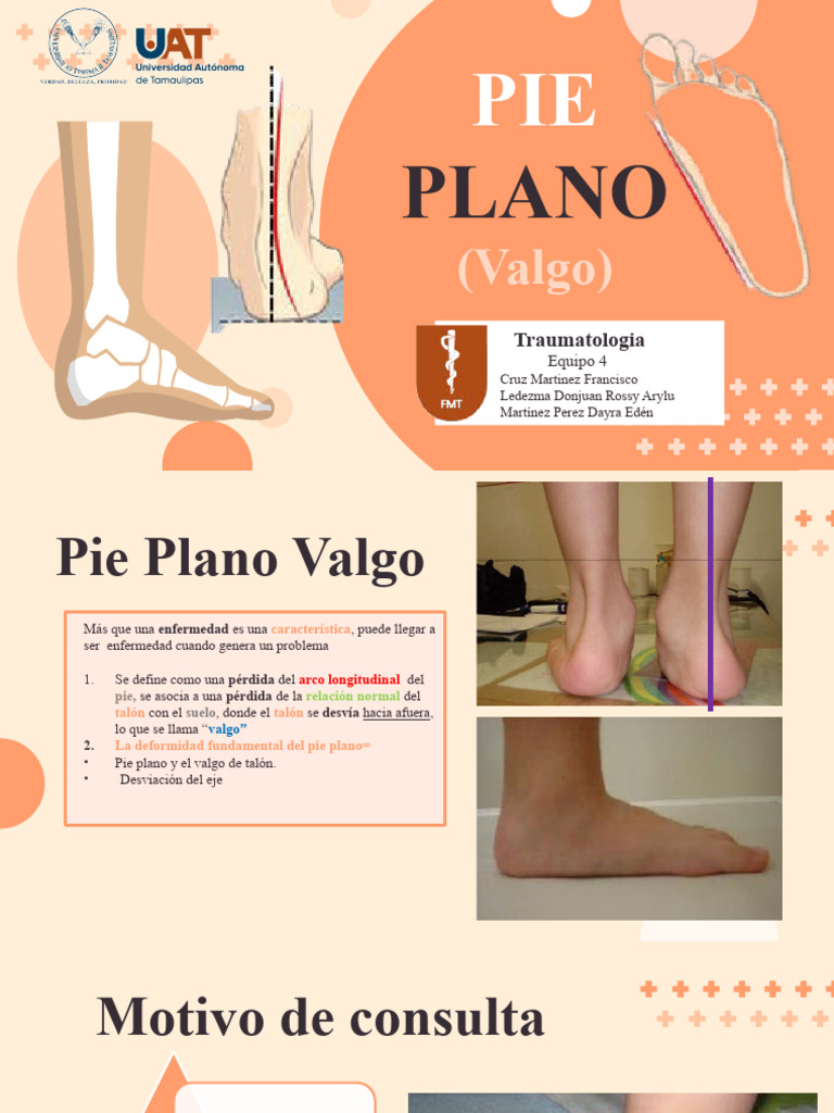 Pie Plano Valgo: Diagnóstico y Tratamiento | PDF | Pie | Sistema ...