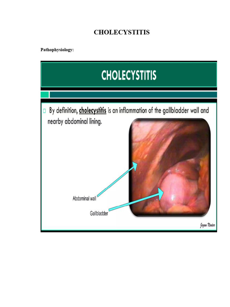 Cholecystitis | PDF