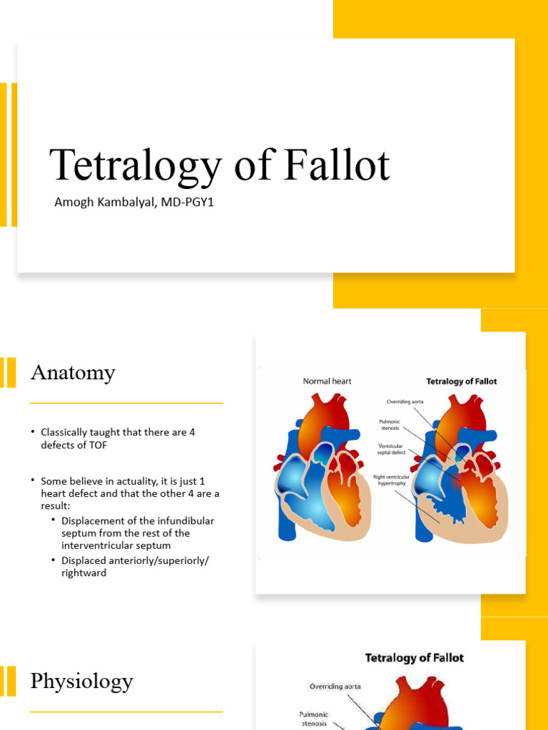 Tetralogy of Fallot: Overview & Management | PDF | Wellness | Science ...