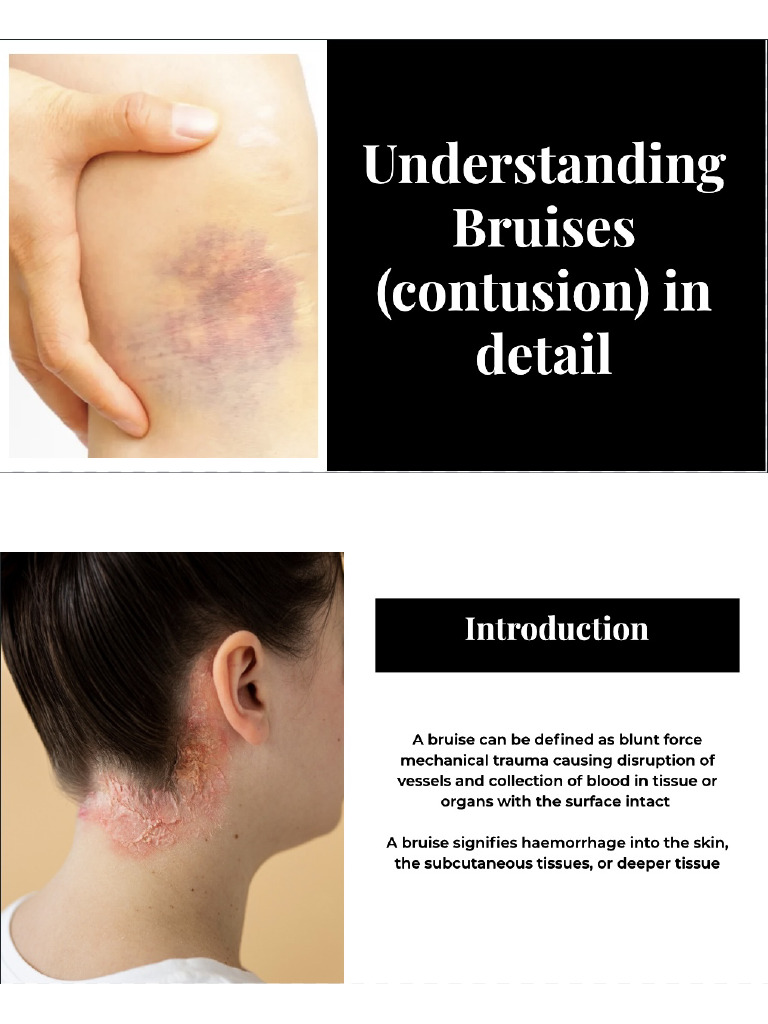 Bruise ppt | PDF