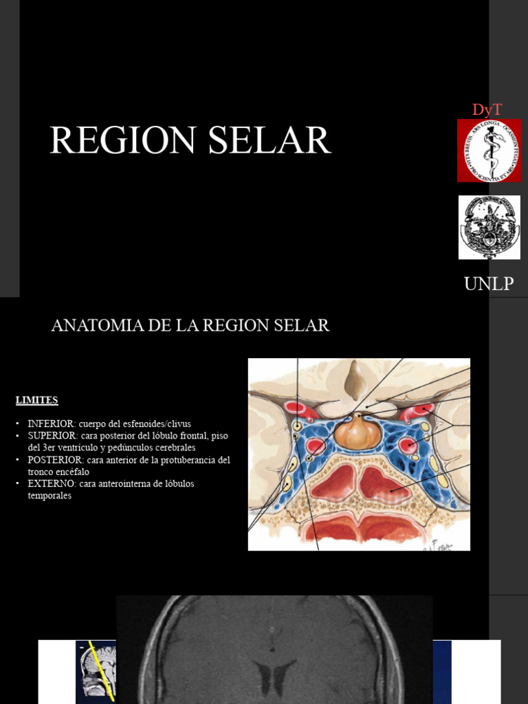 Diagnostico por Imagenes Region Selar | PDF | Glándula pituitaria ...