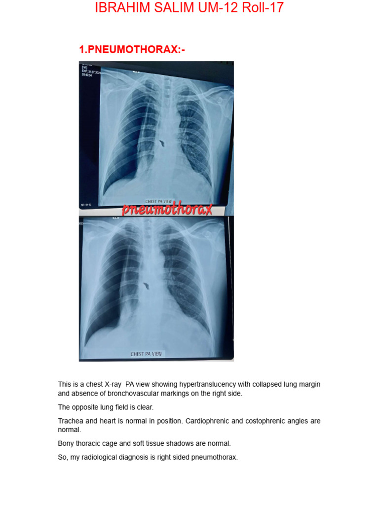 XRAY (Ibrahim Salim Roll-17 Um-12) | PDF | Thorax | Lung