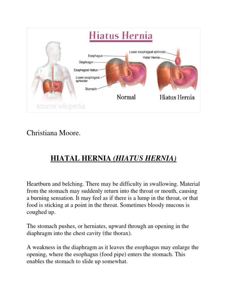 #1hiatal Hernia (Hiatus Hernia #1 | PDF | Esophagus | Stomach