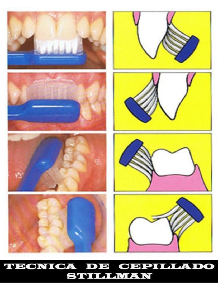 Técnica de stillman | PDF