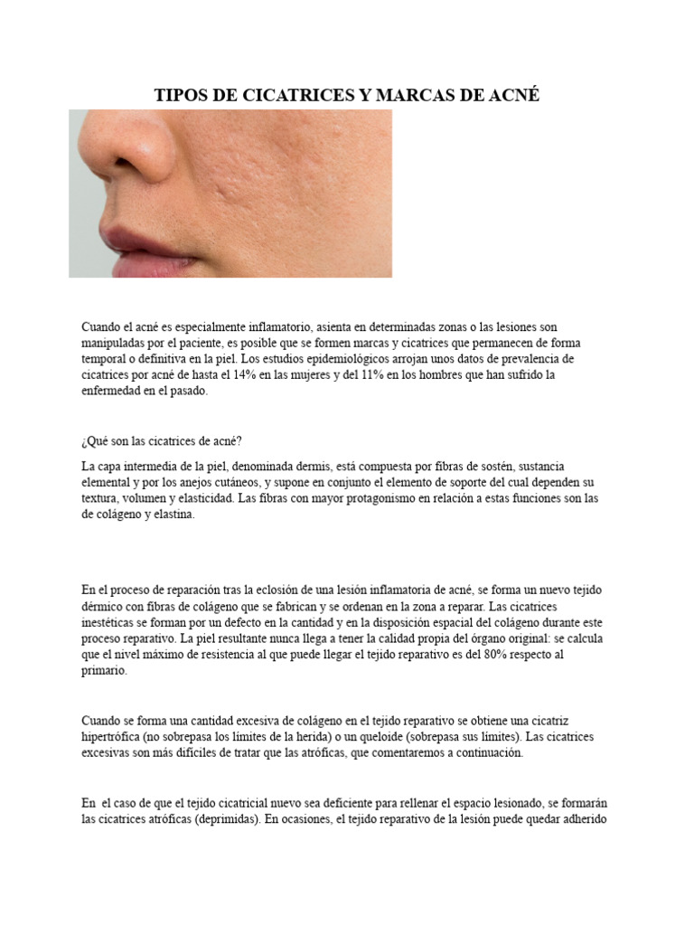 TIPOS DE CICATRICES Y MARCAS DE ACNÉ | PDF | Cicatriz | Cicatrización de la herida