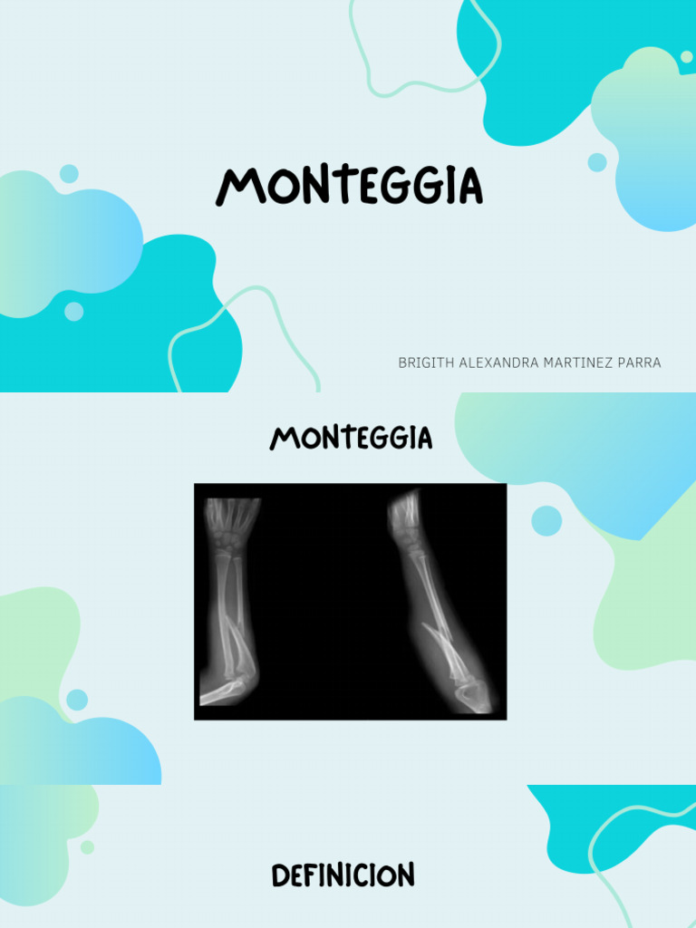 Fractura de Monteggia | PDF