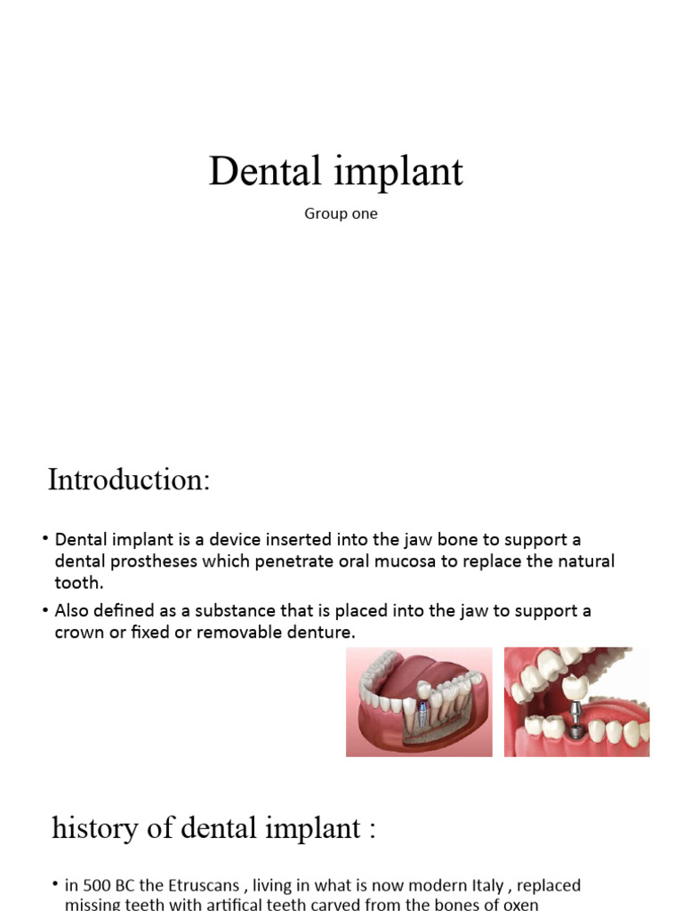 Dental Implant | PDF | Dental Implant | Dentures
