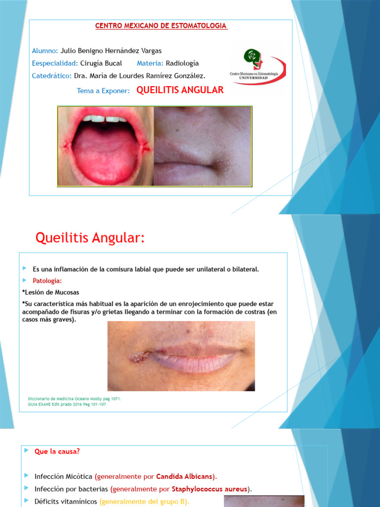 Queilitis Angular Causas Y Tratamientos Pdf