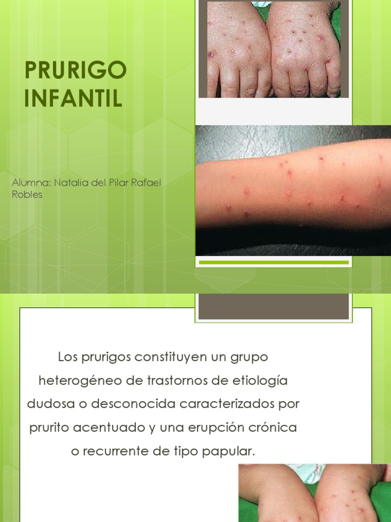 Prurigo Infantil | PDF | Medicina CLINICA | Enfermedades y trastornos
