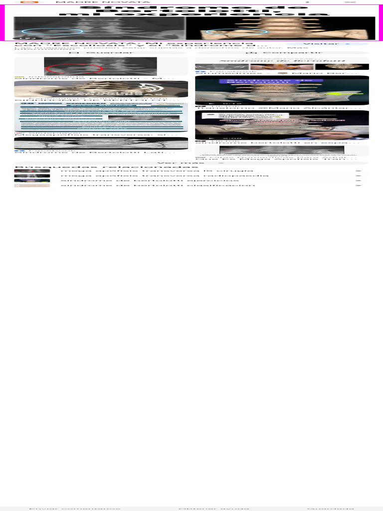 Mega Apofisis Transversa l5 Bilateral No Articuladas Al Sacro - Buscar ...