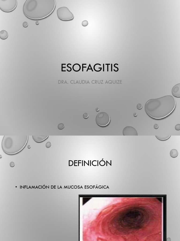 Clasificación y tratamiento de esofagitis | PDF | La enfermedad por ...