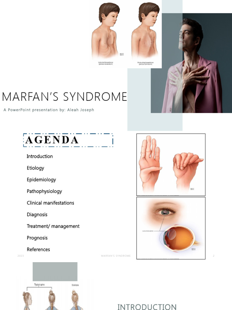 Understanding Marfan Syndrome: Overview and Management | PDF | Medical ...